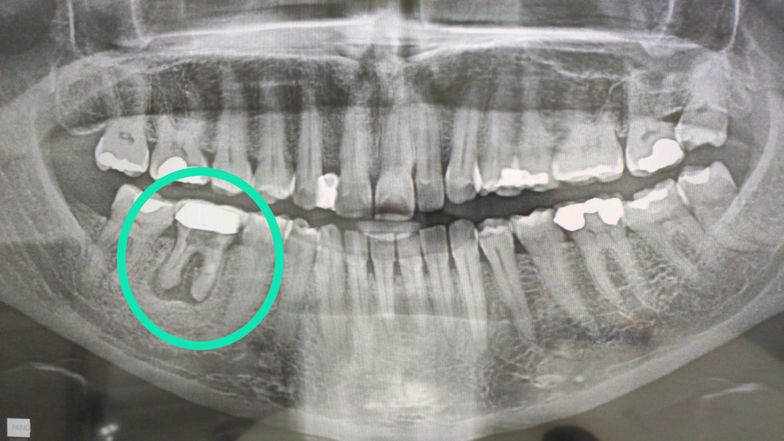 APERTURA Y DRENAJE DE ABSCESO - Dental Mulet